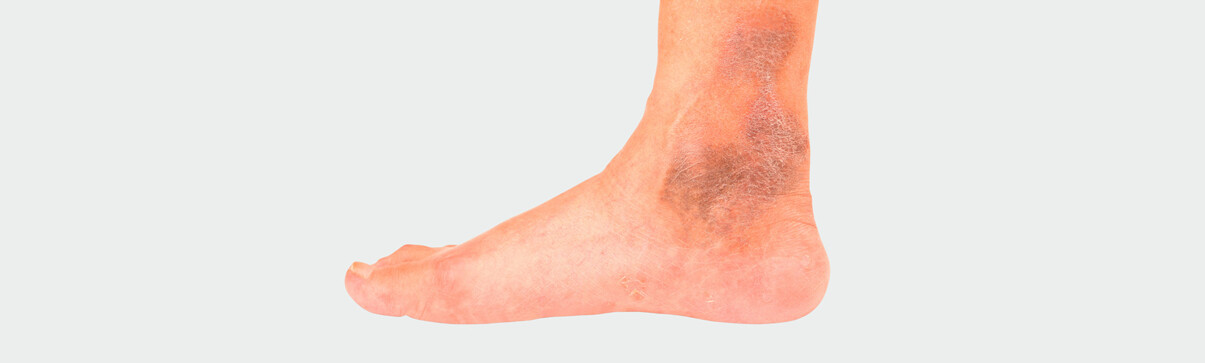 Kronisk venös insufficiens - Juzo