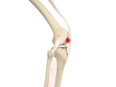 Entezopatia więzadła rzepki - Juzo